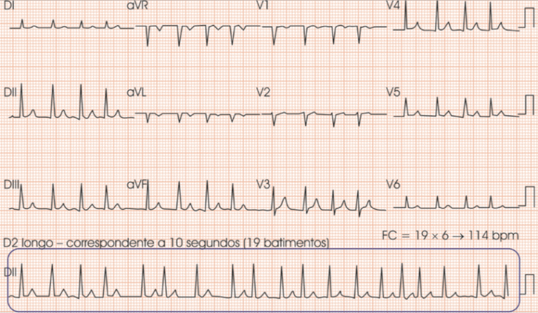 Como definir a frequência cardíaca pelo ECG quando o ritmo cardíaco é ...